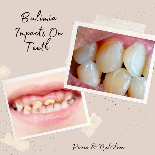 "Bulimia Face" and Teeth: Signs and Symptoms Explained | Peace & Nutrition™